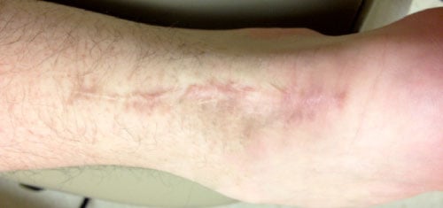 Surgical Scar Treatment: Options from Dr. Bob in Los Angeles