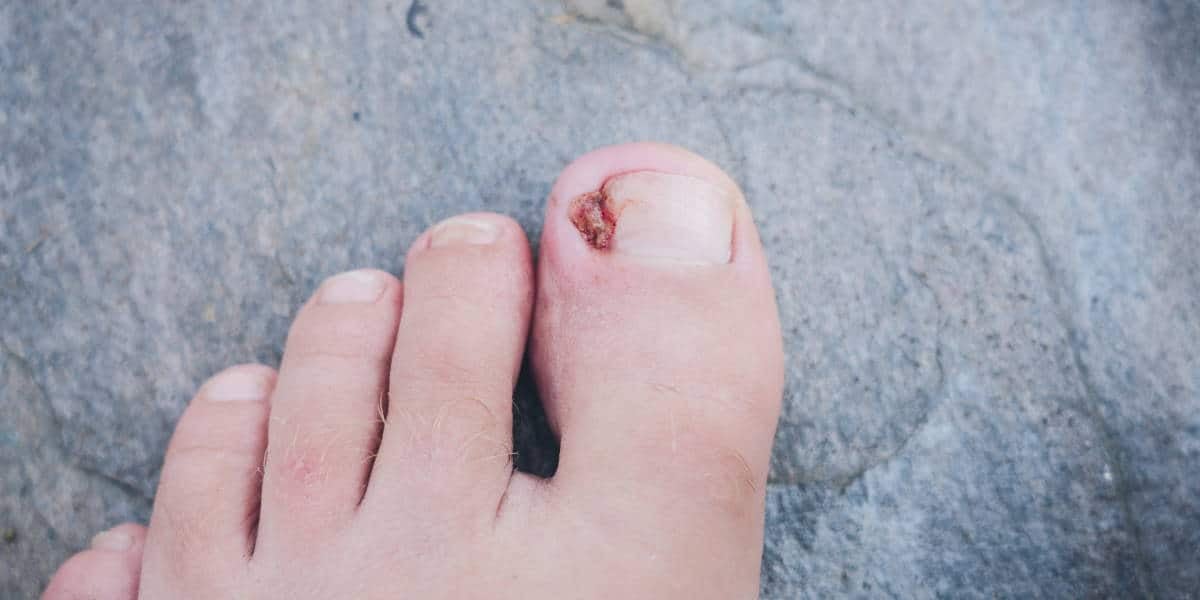 Ingrown Toenail? Dr. Bob's Guide to Infection Care in 2025