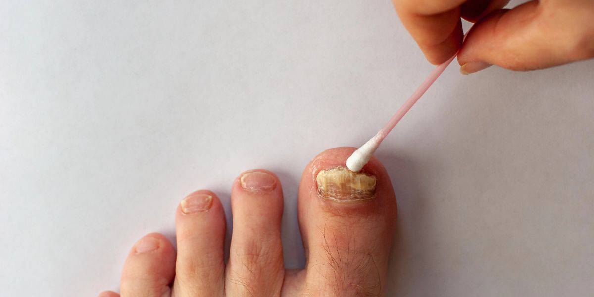 Toenail Falling Off? Dr. Bob's Guide & Treatment (2025)