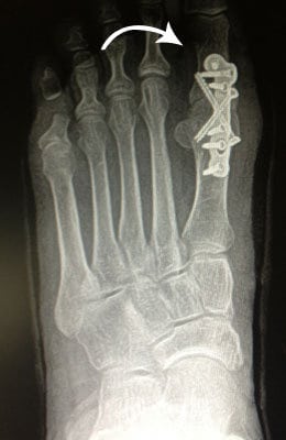 Hallux Rigidus / Big Toe Arthritis Before & After Pictures - Dr. Bob ...