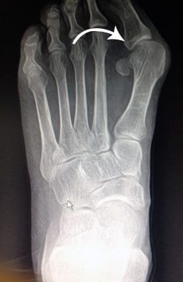 Hallux Rigidus / Big Toe Arthritis Before & After Pictures - Dr. Bob ...