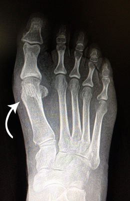Hallux Rigidus / Big Toe Arthritis Before & After Pictures - Dr. Bob ...