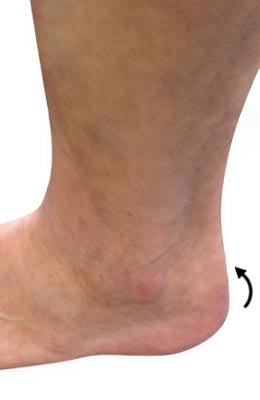Achilles Tendon Repair Surgery: Before & After Pictures - Dr. Bob ...