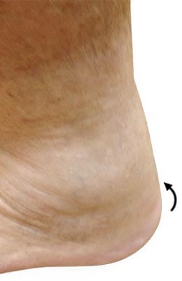 Achilles Tendon Repair Surgery: Before & After Pictures - Dr. Bob ...