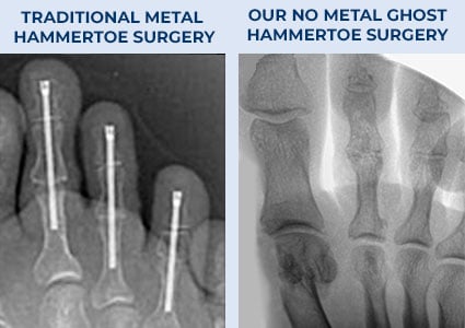 Expert Hammer Toe Care in Los Angeles | Foot & Ankle Specialist