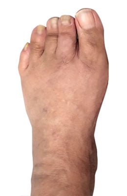 Bunion Surgery Before & After Pictures - Dr. Bob Baravarian