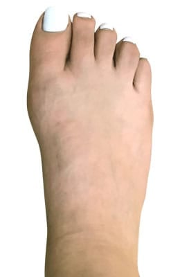 Dr. Bob's Bunion Surgery: Before & After Pictures