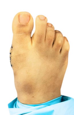 Bunion Surgery Before & After Pictures - Dr. Bob Baravarian