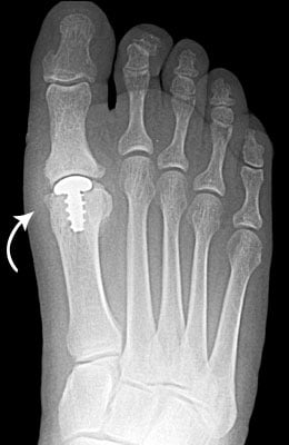 Toe Correction Surgery Before & After Pictures - Dr. Bob Baravarian
