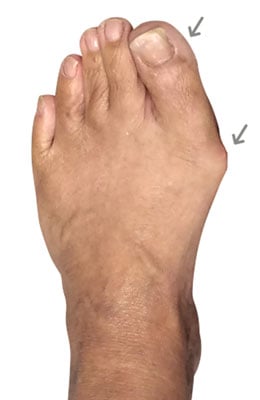 Bunion Surgery Before & After Pictures - Dr. Bob Baravarian