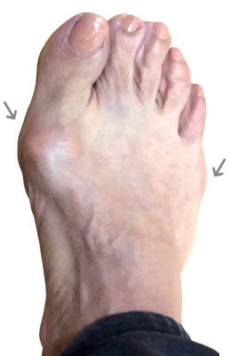 Dr. Bob's Bunion Surgery: Before & After Pictures