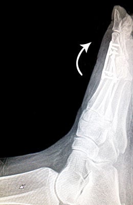 Toe Correction Surgery Before & After Pictures - Dr. Bob Baravarian