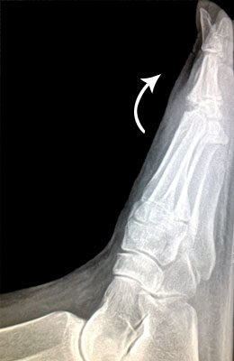 Toe Correction Surgery Before & After Pictures - Dr. Bob Baravarian