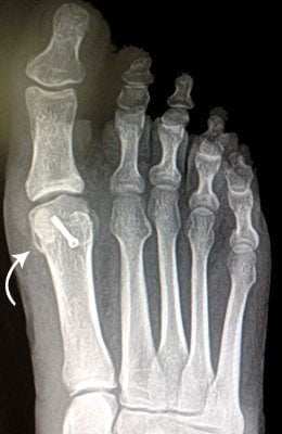 Hallux Rigidus / Big Toe Arthritis Before & After Pictures - Dr. Bob ...