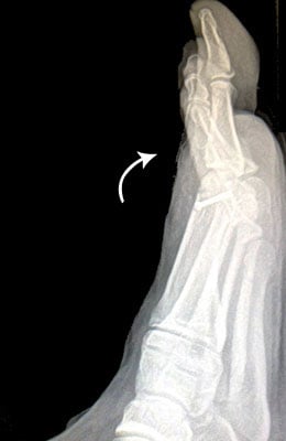 Hallux Rigidus / Big Toe Arthritis Before & After Pictures - Dr. Bob ...
