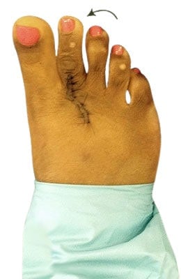 Toe Correction Surgery Before & After Pictures - Dr. Bob Baravarian