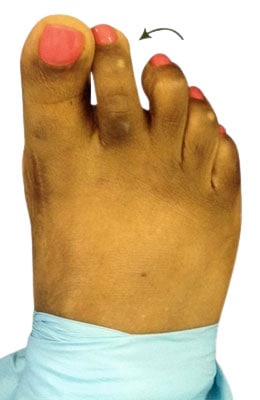 Toe Correction Surgery Before & After Pictures - Dr. Bob Baravarian