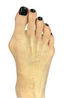 Bunion Surgery Before & After Pictures - Dr. Bob Baravarian