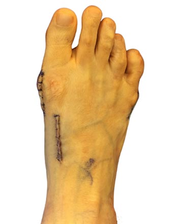 Bunion Surgery Before & After Pictures - Dr. Bob Baravarian
