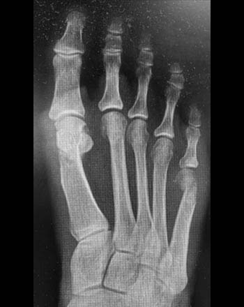Bunion Surgery Before & After Pictures - Dr. Bob Baravarian