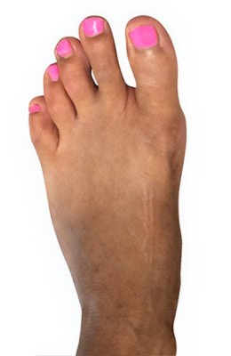 Bunion Surgery Before & After Pictures - Dr. Bob Baravarian