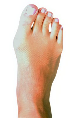 Bunion Surgery Before & After Pictures - Dr. Bob Baravarian
