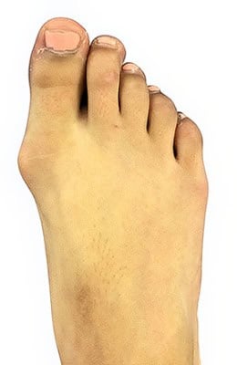 Bunion Surgery Before & After Pictures - Dr. Bob Baravarian