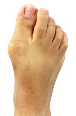 Bunion Surgery Before & After Pictures - Dr. Bob Baravarian